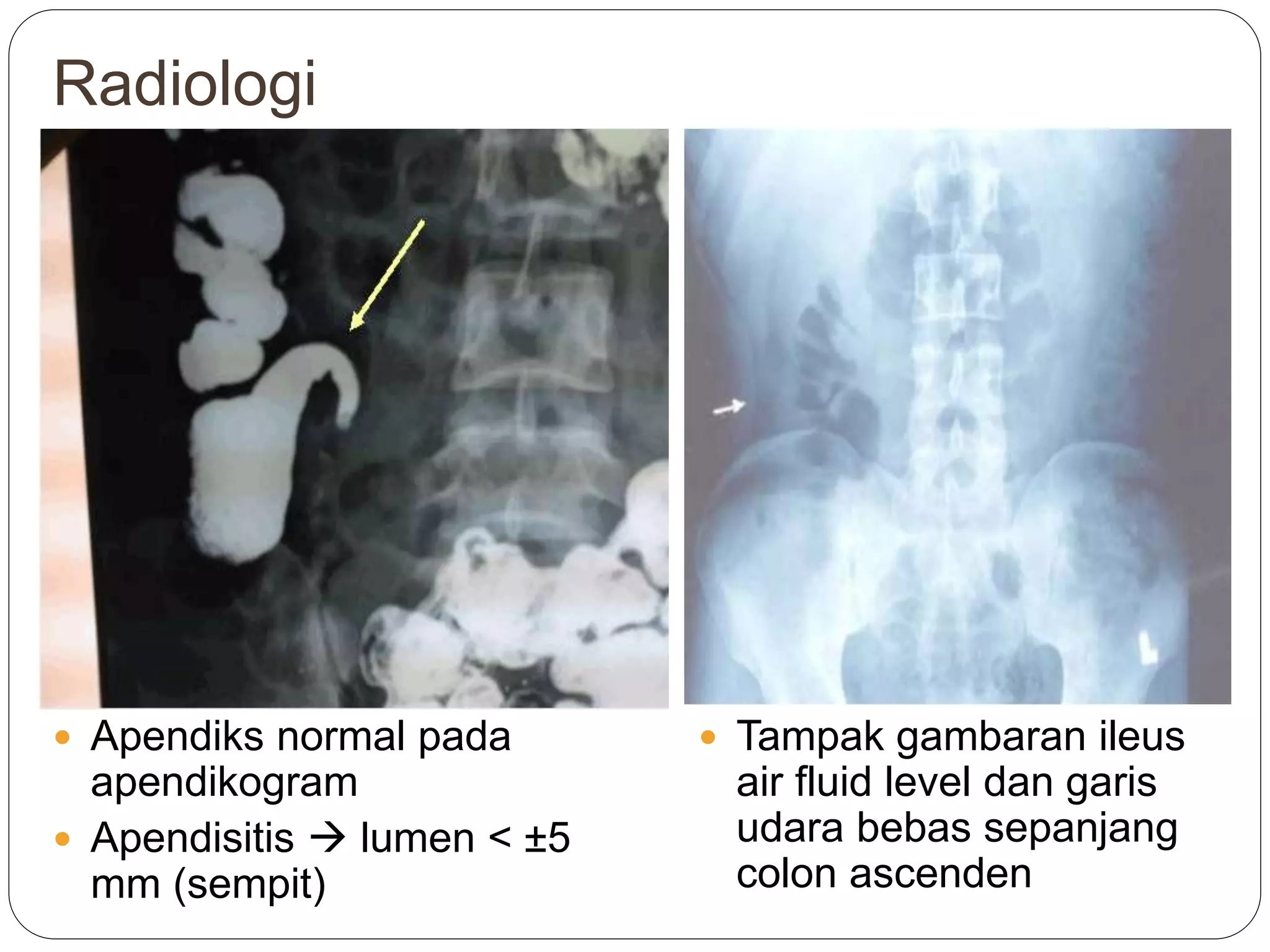 Peri apendikuler infiltrat | PPTX