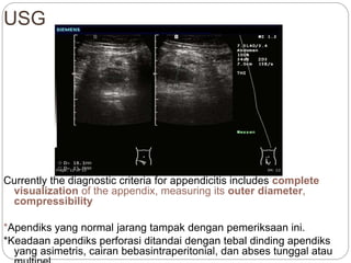 Peri apendikuler infiltrat | PPTX