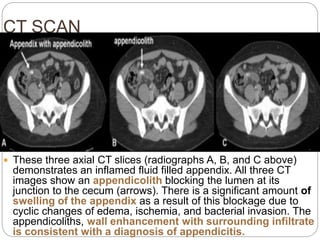 Peri apendikuler infiltrat | PPTX
