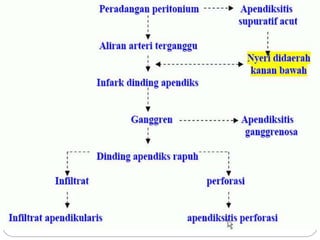 Peri apendikuler infiltrat | PPTX