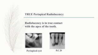 Differential diagnosis of periapical radiolucent lesion | PPTX