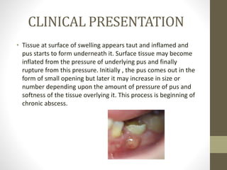 Periapical Abscess.pptx