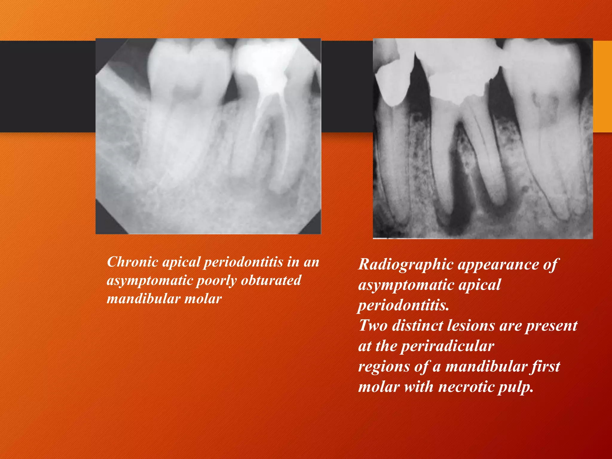 Periapical diseases and classification | PPTX