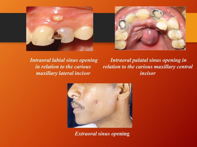 Periapical diseases and classification | PPTX | Dental Health ...