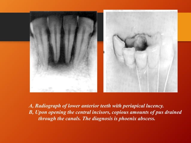 Periapical diseases and classification | PPTX | Dental Health ...