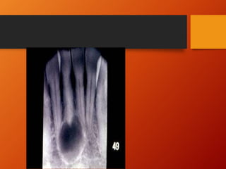 Periapical diseases and classification | PPTX
