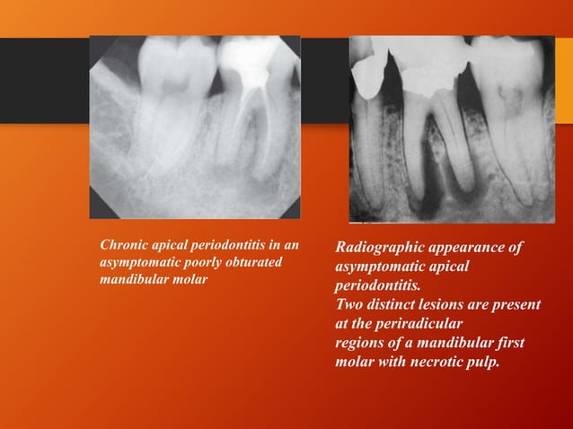 Periapical diseases and classification