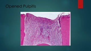 Periapical and pulp diseases | PPTX