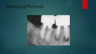 Periapical and pulp diseases | PPT