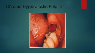 Periapical and pulp diseases | PPT