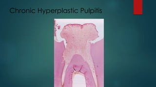 Periapical and pulp diseases | PPT