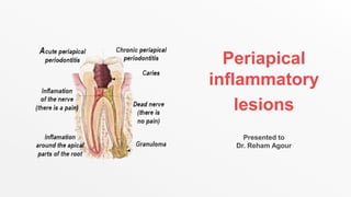 Periapical inflammatory lesions with case study | PPT