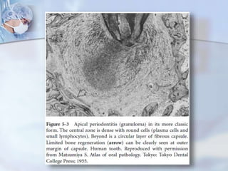 Periapical Abscess Histology
