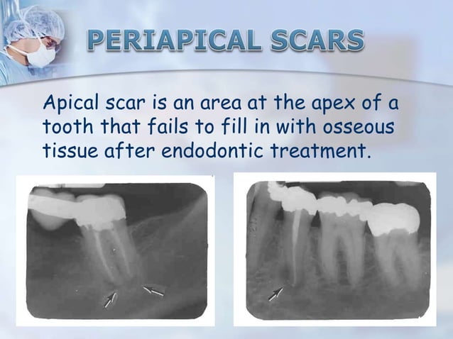 Periapical pathology