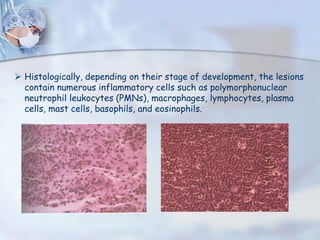 Periapical Abscess Histology