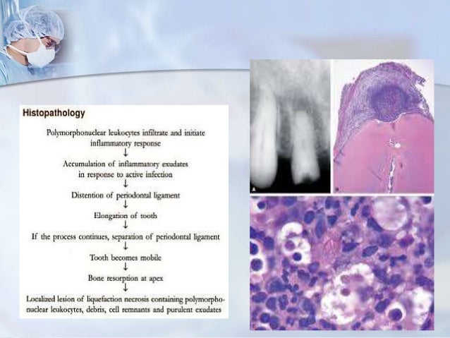 Periapical Abscess Histology Six Cases Report Of Differential
