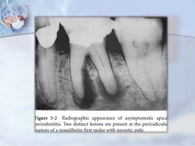 Periapical pathology