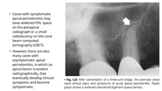 periapical pathology in endodontic dentistry | PPTX