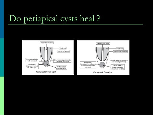 Periapical Granuloma Vs Cyst