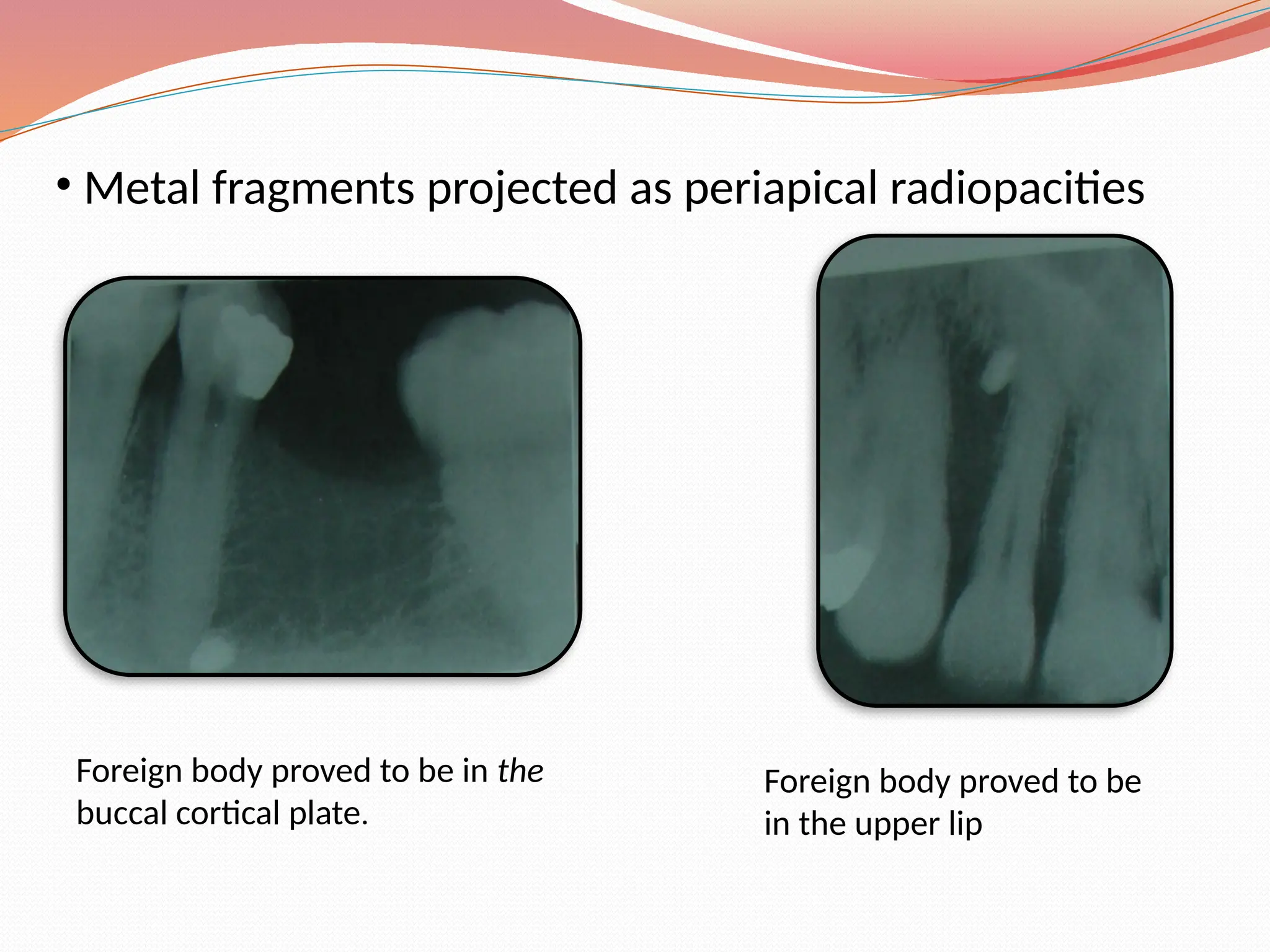 periapical & pericoronal radiopacity.pptx