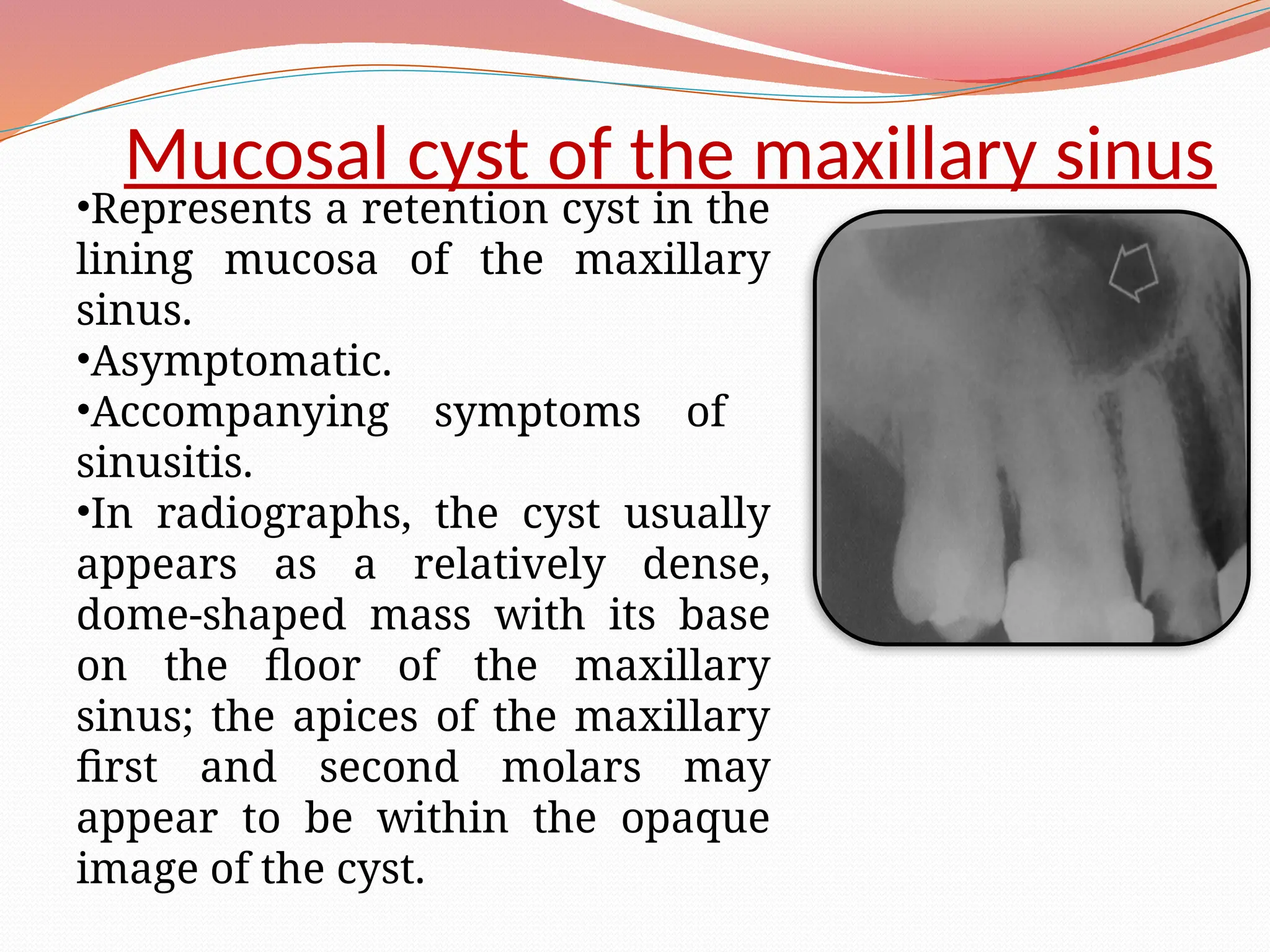 periapical & pericoronal radiopacity.pptx