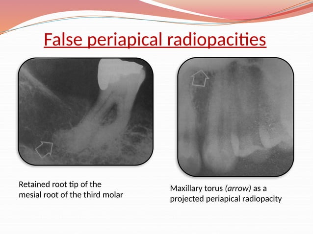 periapical & pericoronal radiopacity.pptx