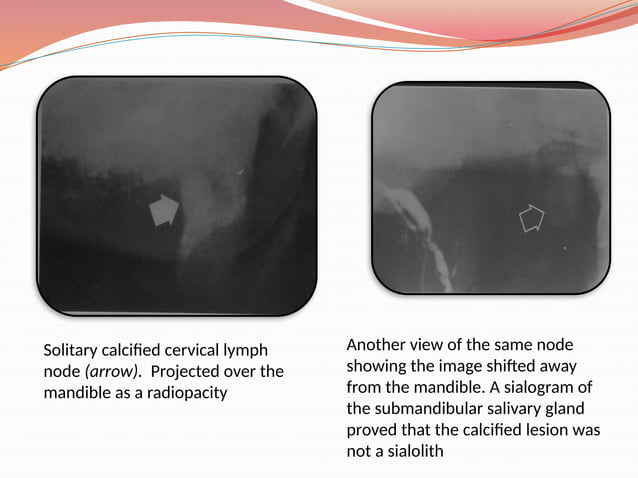 periapical & pericoronal radiopacity.pptx