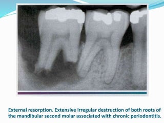 Periapical power point | PPT