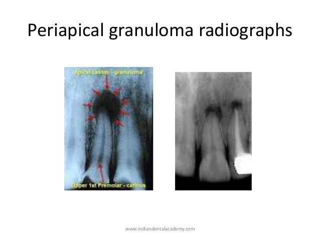 Periapical radiolucencies./ oral surgery courses
