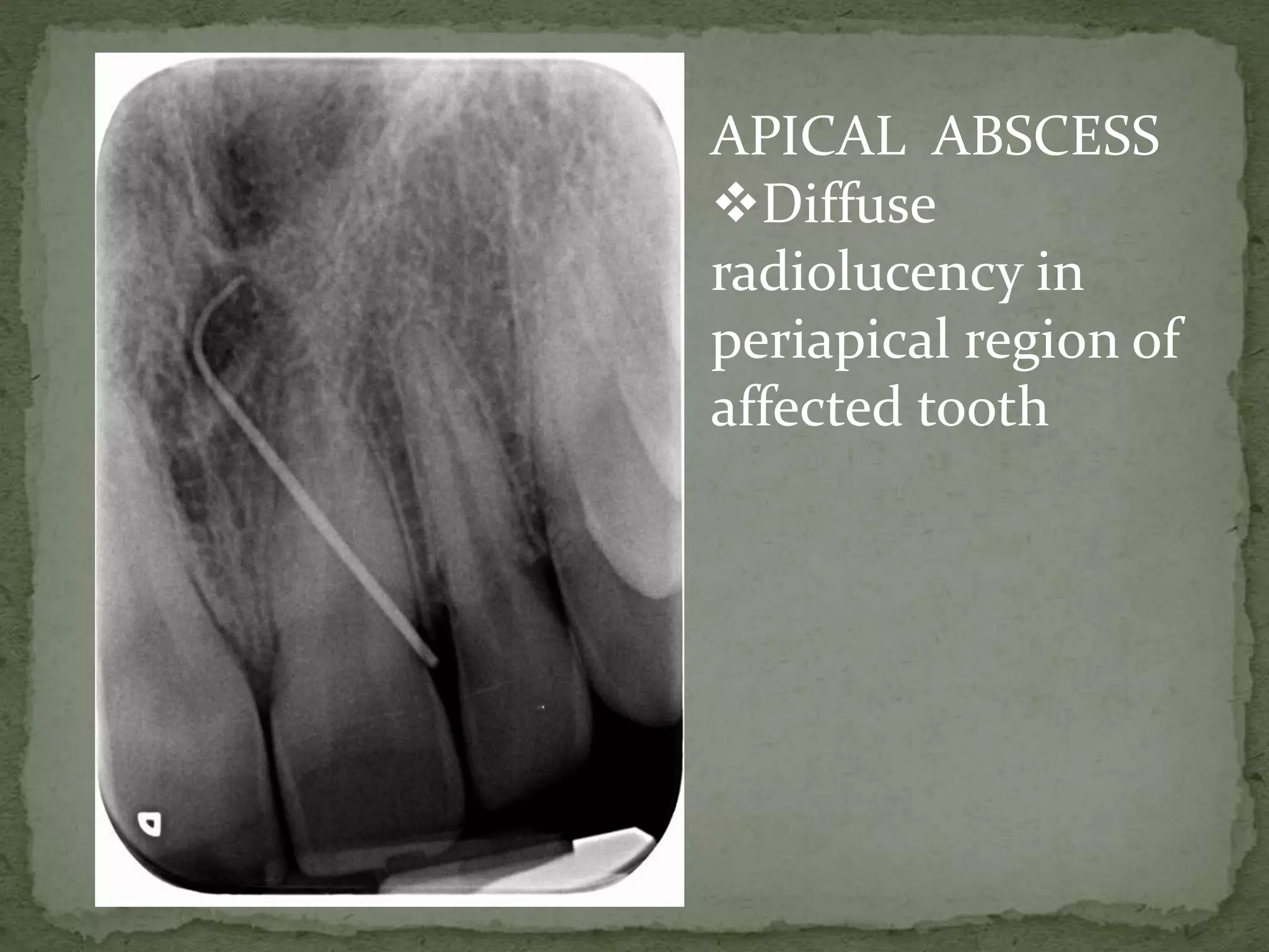 Periapical radiolucencies | PPTX