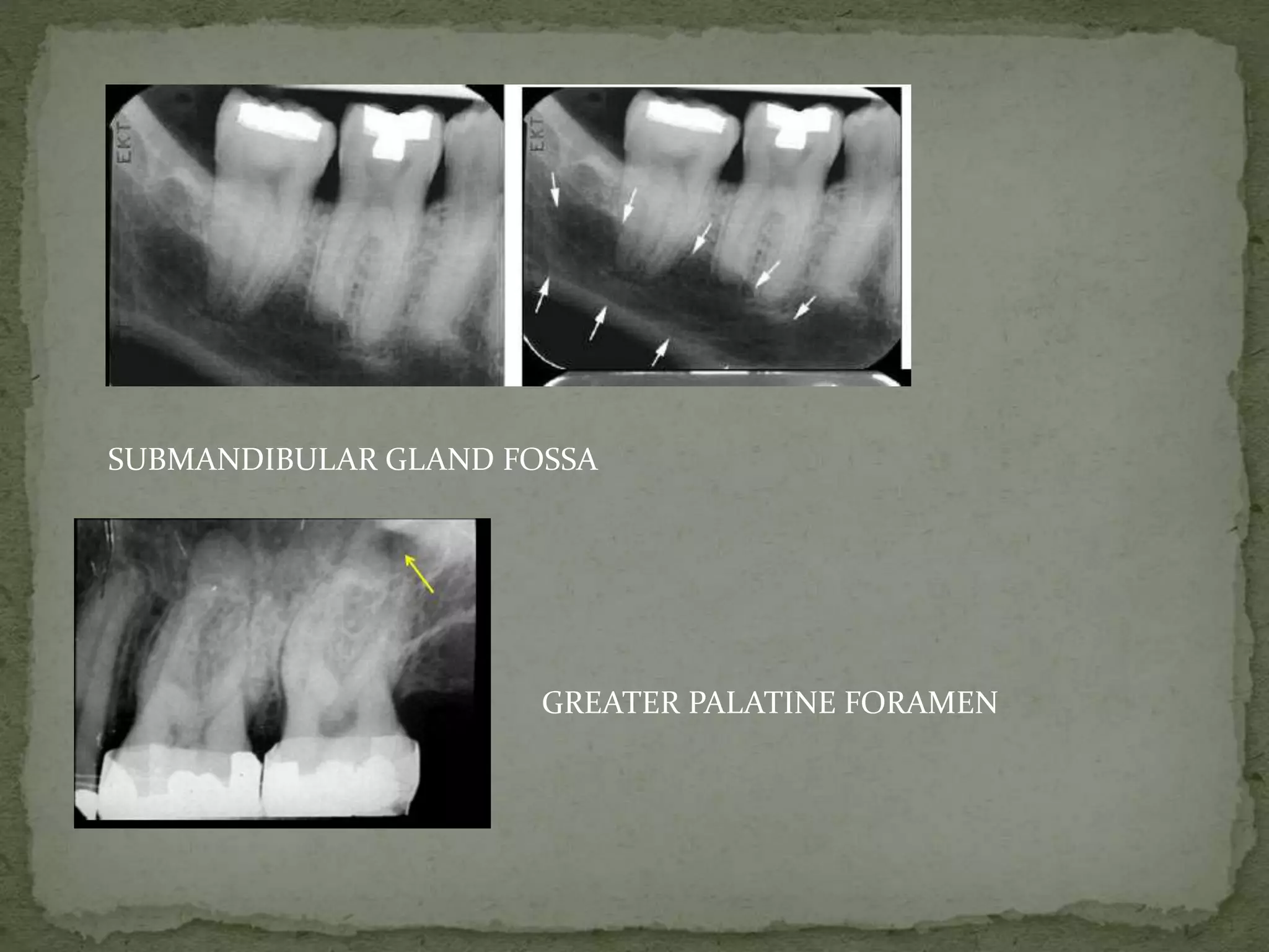 Periapical radiolucencies | PPTX