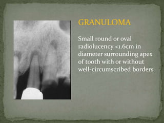 Periapical radiolucencies | PPTX