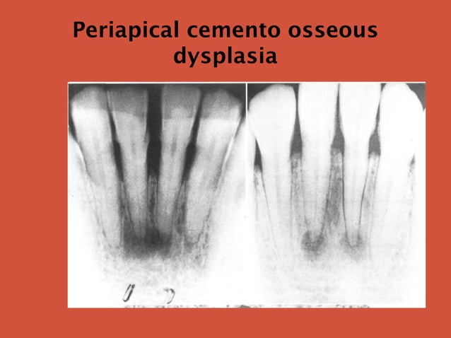 Tooth periapical radiolucencies and radiopacities.pptx
