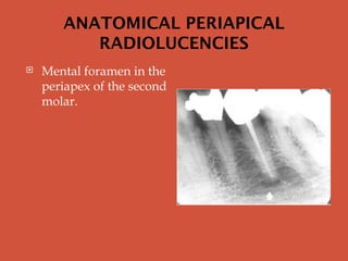 Tooth periapical radiolucencies and radiopacities.pptx