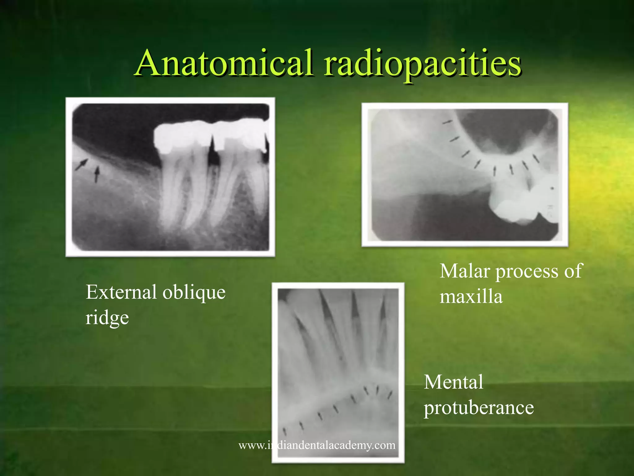 Periapical radiopacities/ dental implant courses | PPTX