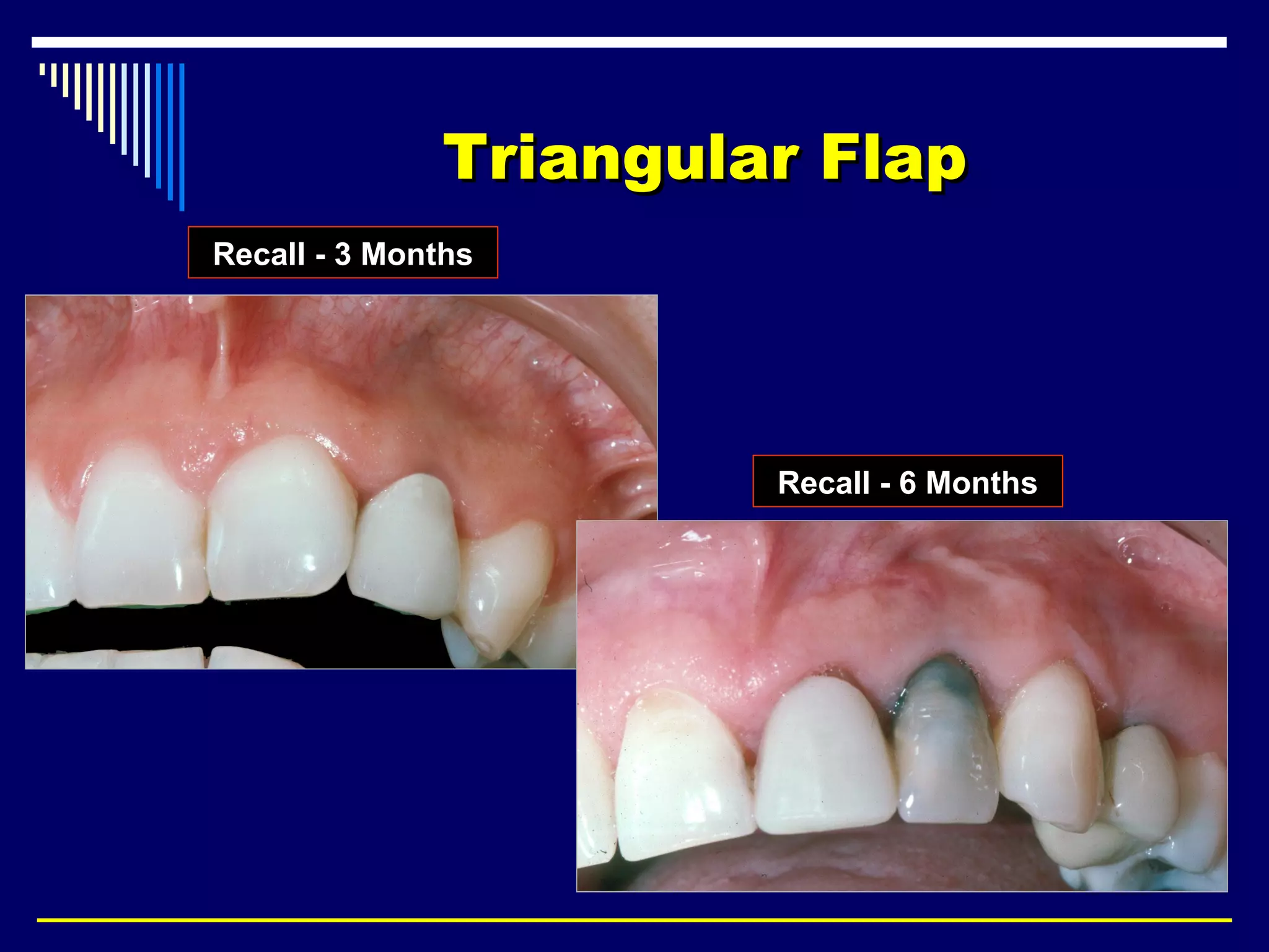 Periapical surgery | PPT