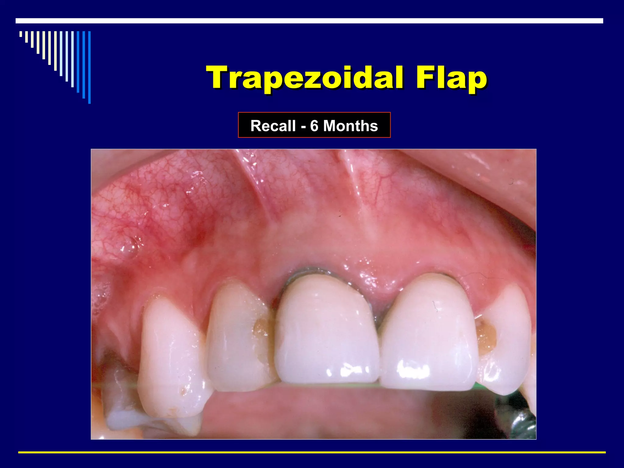 Periapical surgery | PPT