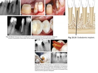 periapical surgery: A brief introduction.pptx