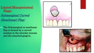 Periapical surgery viji | PPTX