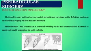 Periapical surgery viji | PPTX