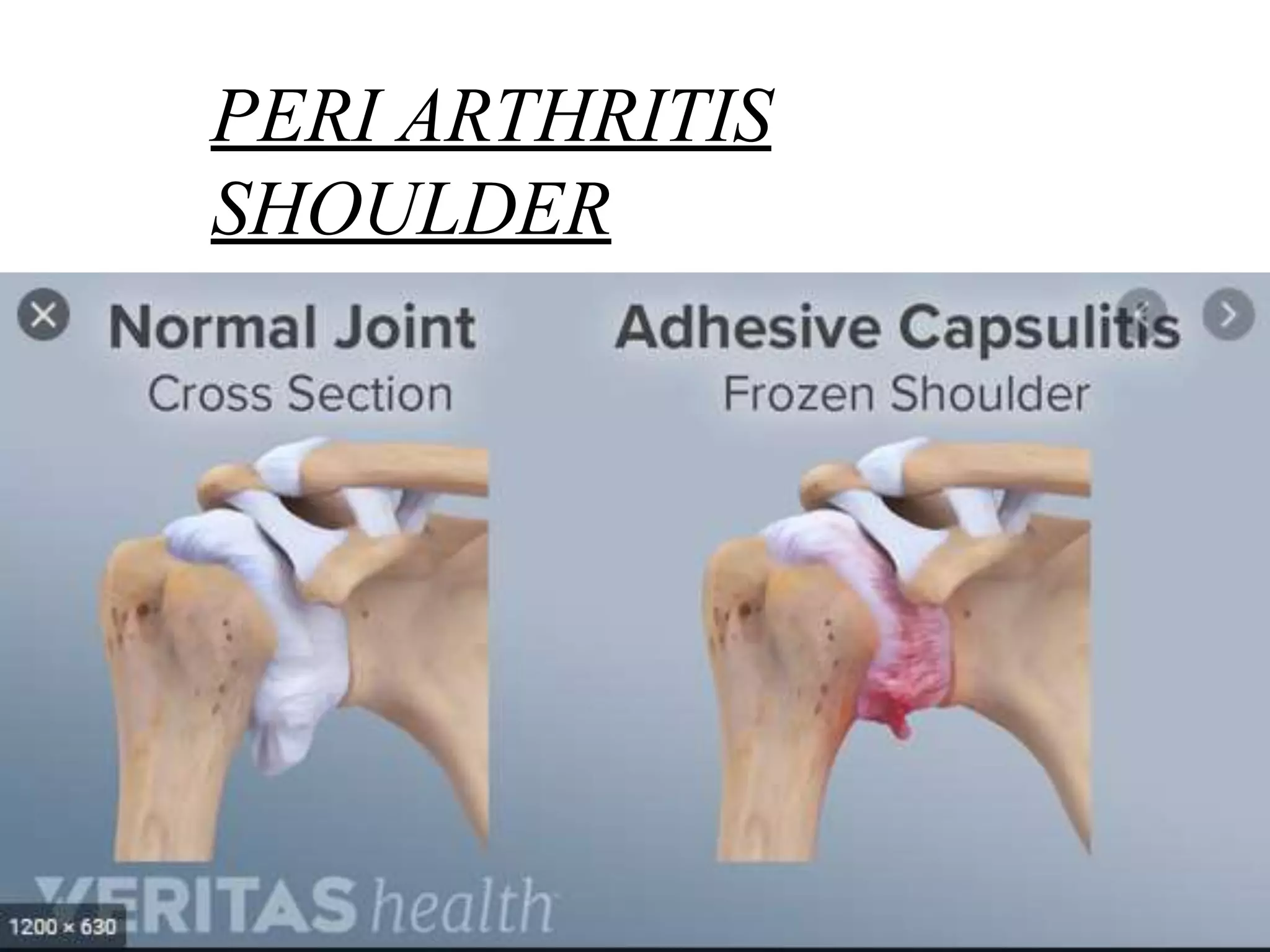 Periarthritis shoulder & painful arc | PPTX