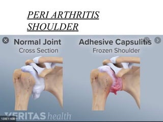 Periarthritis shoulder & painful arc | PPTX