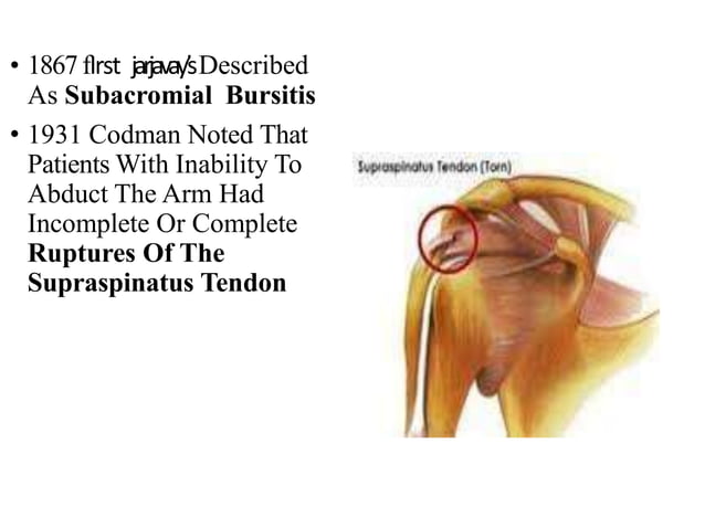 Periarthritis shoulder & painful arc | PPTX