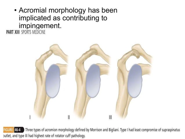 Periarthritis shoulder & painful arc | PPTX