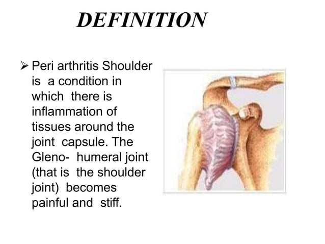 Periarthritis shoulder & painful arc | PPTX