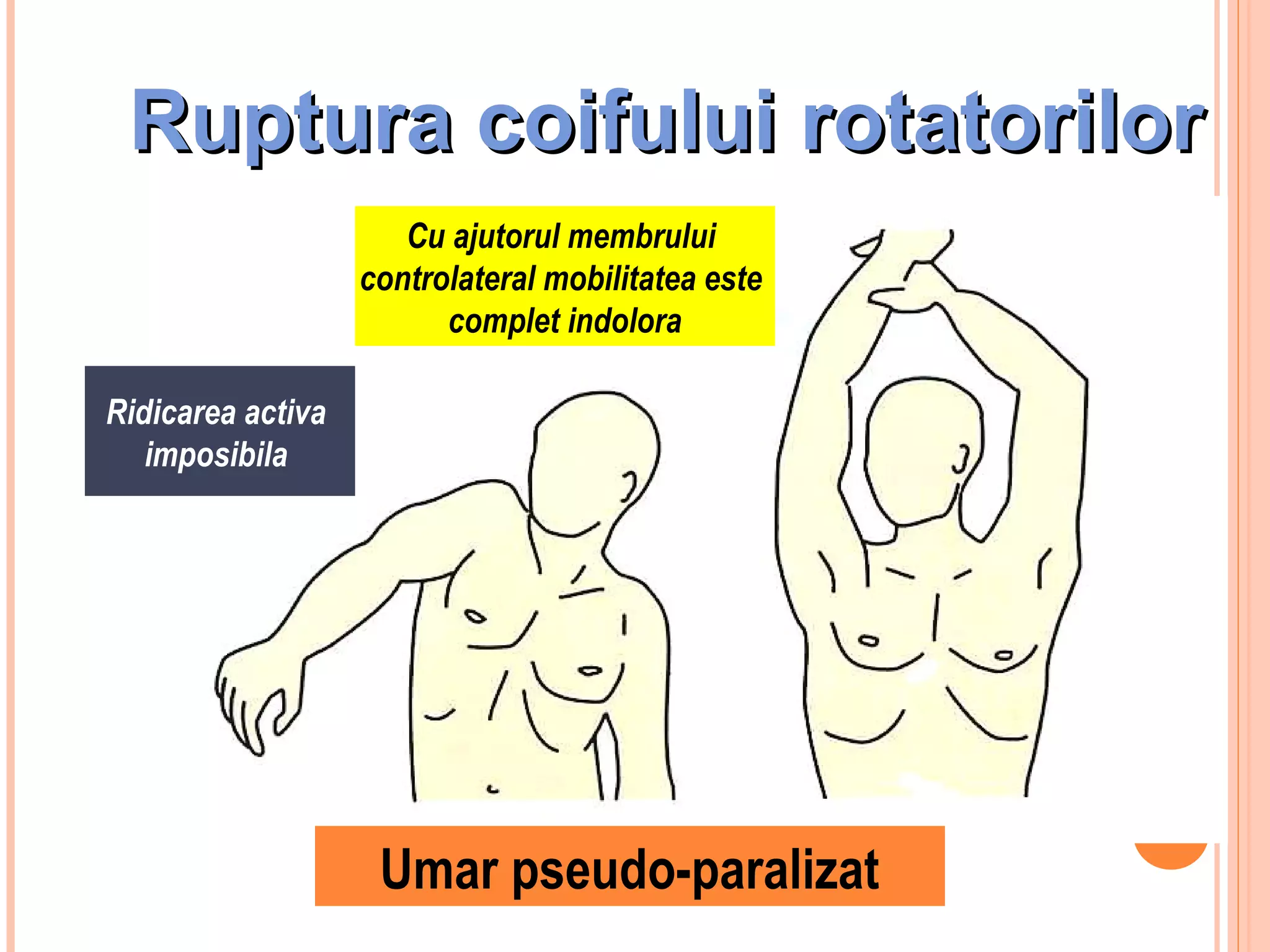Periartrita scapulo humerala | PPT