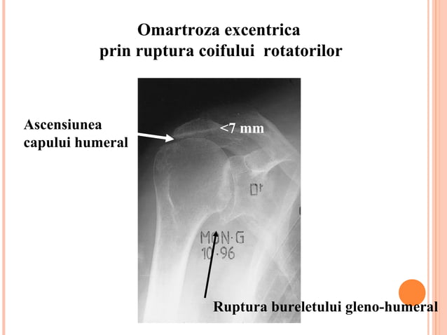 Periartrita scapulo humerala | PPT