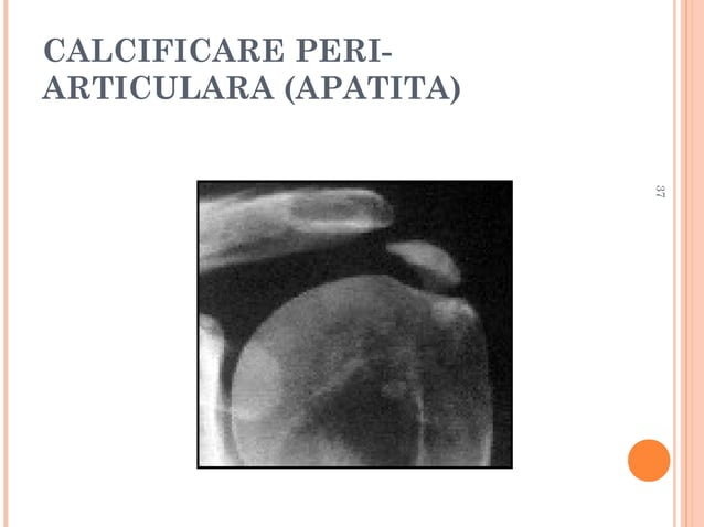 Periartrita scapulo humerala | PPT