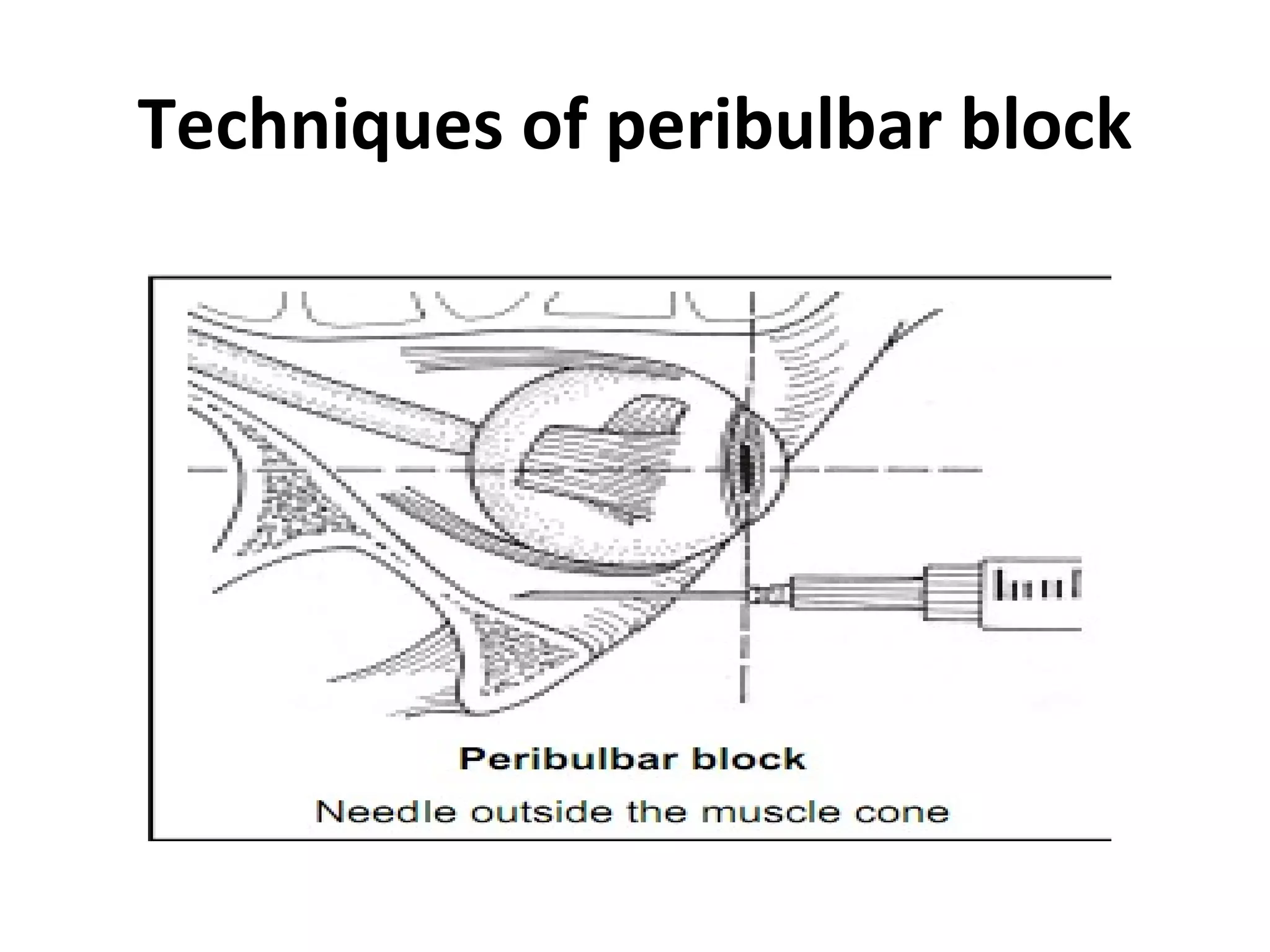 Peribulbar anaesthesia in eye surgery (4) | PPT