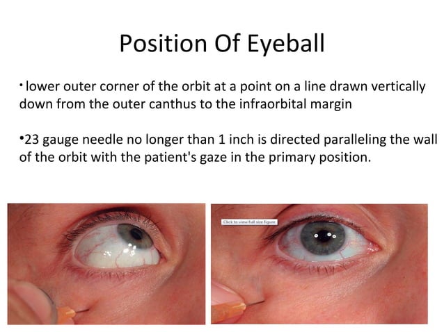 Peribulbar anaesthesia in eye surgery (4) | PPT | Eye and Vision ...
